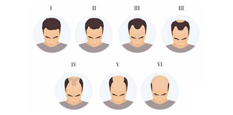 Hair Loss For Teenagers - Reasons and How To Prevent - Medical 11